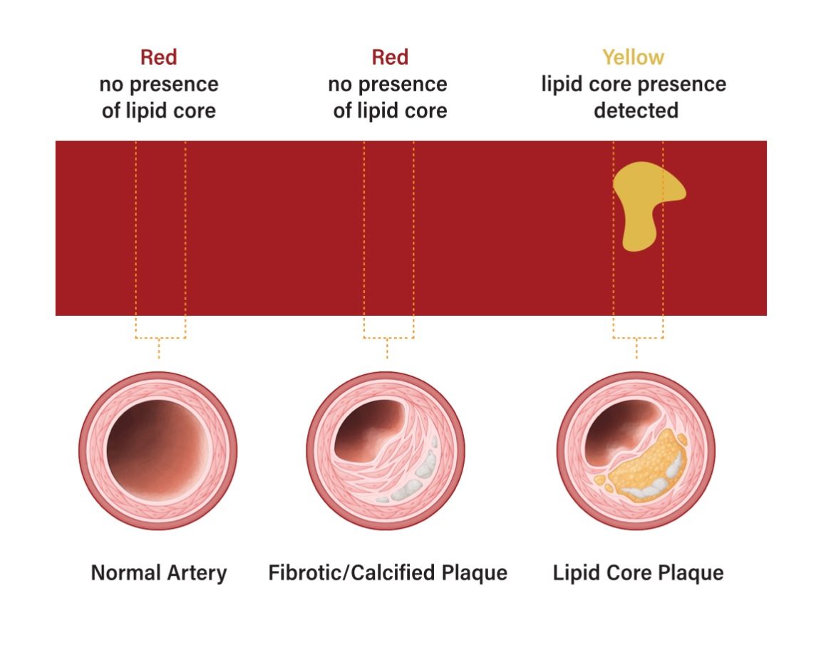 Dualpro® IVUS + NIRS dual-modality catheter | Infraredx™ | Infraredx
